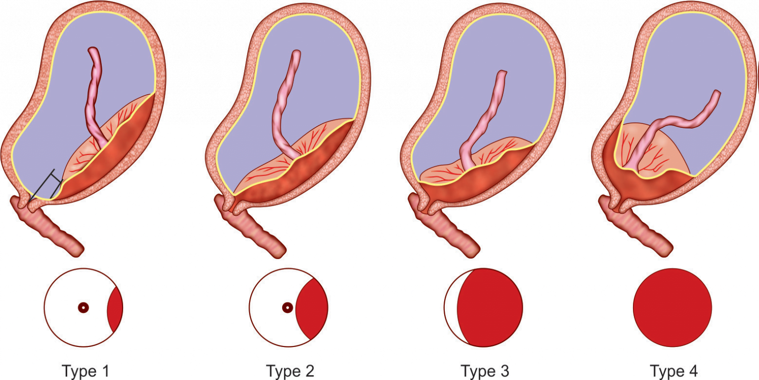 Placenta Previa Theories Types Complications Management And